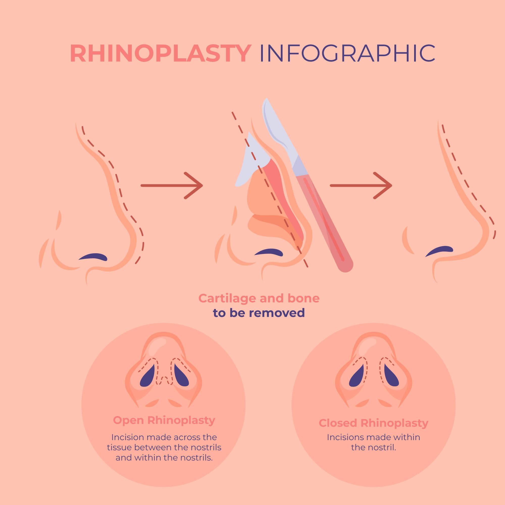 Open Incision Rhinoplasty Nose